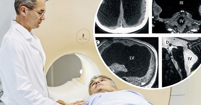 Man Missing Most Of His Brain Changes EVERYTHING We Thought We Knew ...