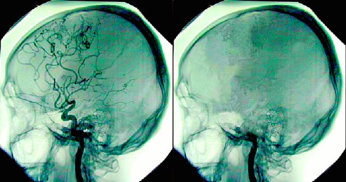 Science Reveals: This Is What Happens In The Brain Before Dying