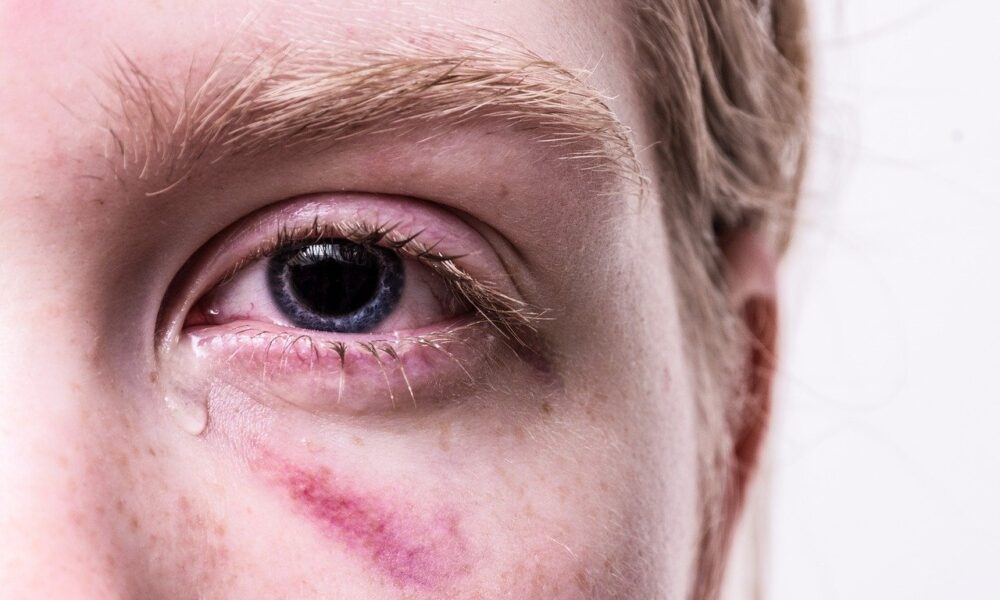 11 Tips To Cope up With the Trauma of Road Injury